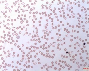 Red Cell Indices - MCV, MCH & MCHC | Hematology Notes