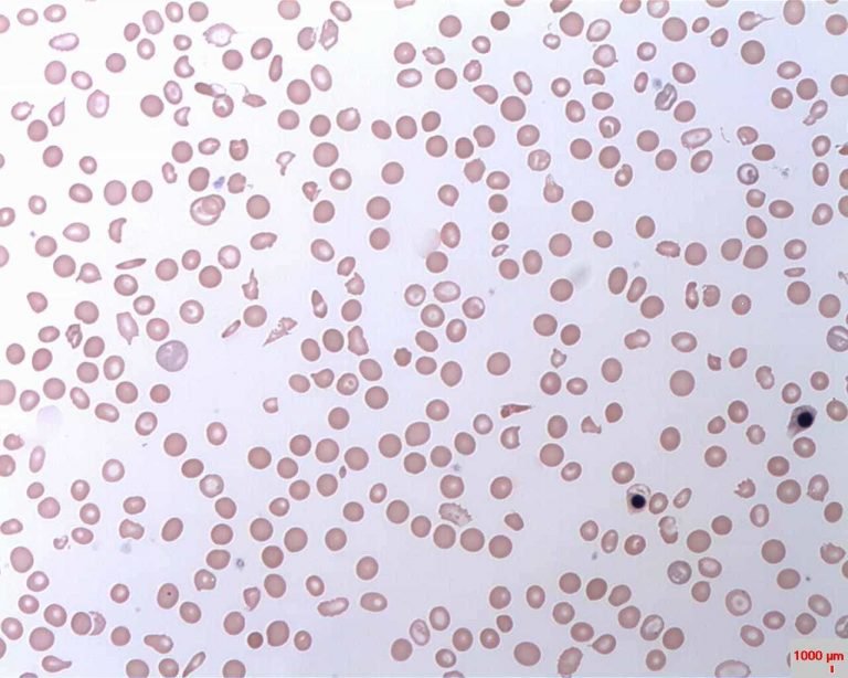 Red Cell Indices - MCV, MCH & MCHC | Hematology Notes