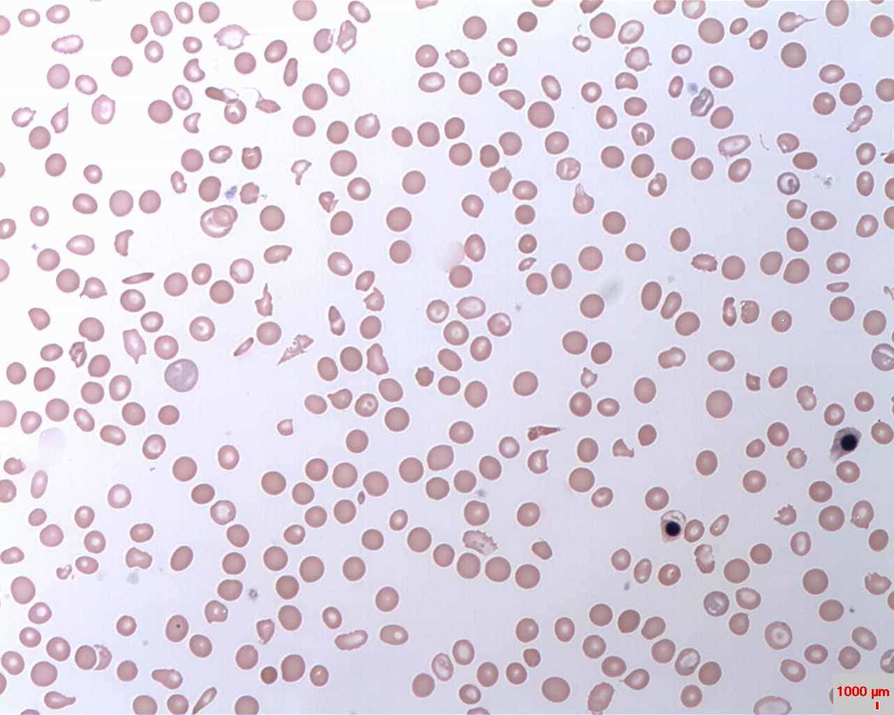 Red Cell Indices - MCV, MCH & MCHC | Hematology Notes