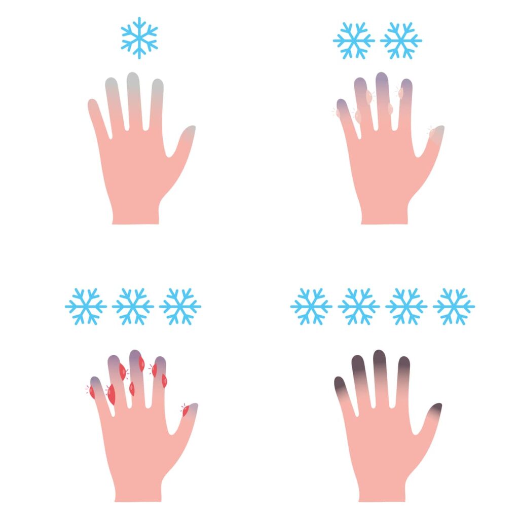 A Complete Guide to Treating and Preventing Frostbite I Paramedics World