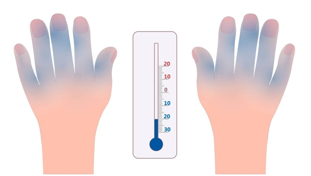 A Complete Guide to Treating and Preventing Frostbite I Paramedics World