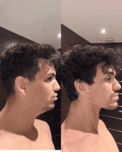 What Is Mewing? Before & After Pictures, Benefits And Risks