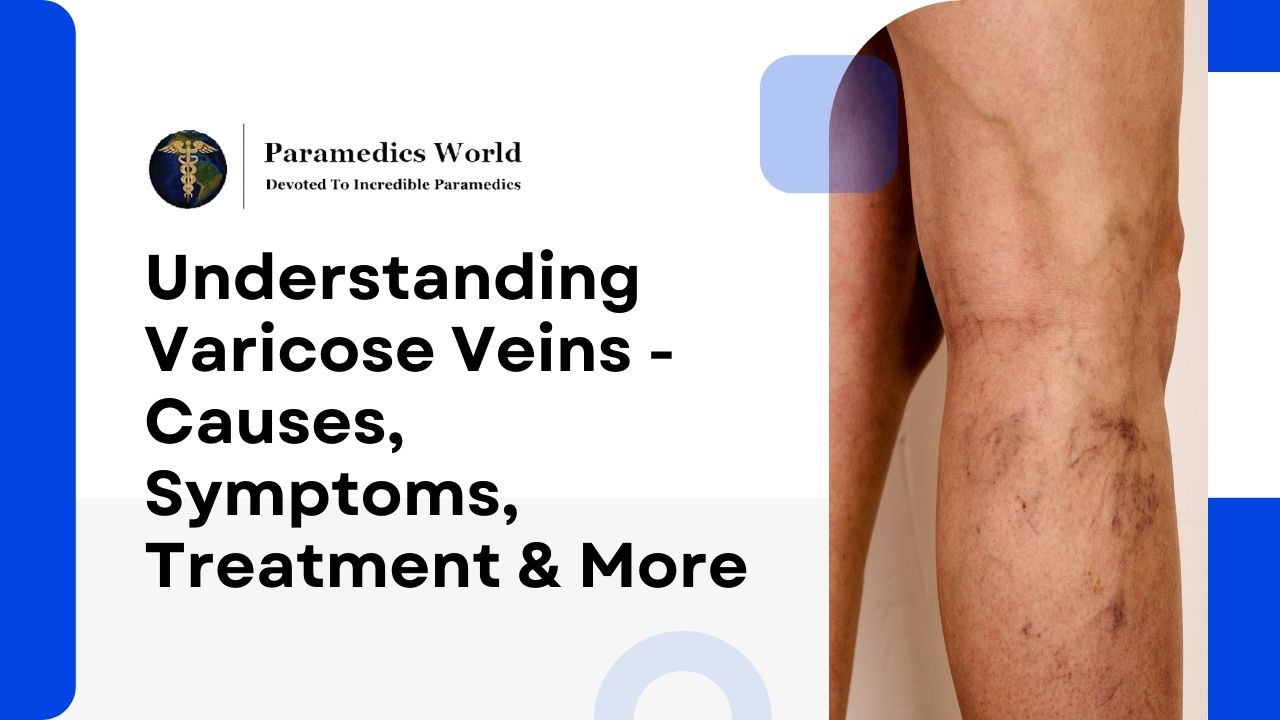 Understanding Varicose Veins - Causes, Symptoms, Treatment & More